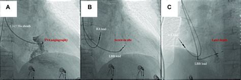 The Procedure To Implant The Left Bundle Branch Pacing Lbbp Lead