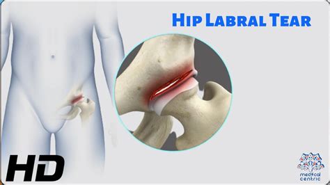 Labral Tear Of Hip Hip Labral Tears Orion Orthopaedic
