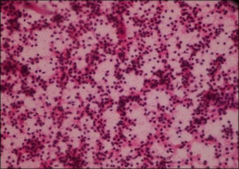 Reactive Lymph Node Hyperplasia Smear Showing A Polymorphous