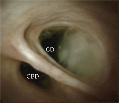 Peroral Cholangioscopy Showed The Mucinous Material Continued To Flow