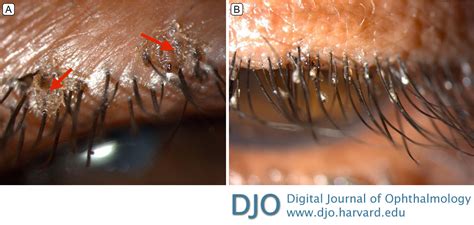 Phthiriasis Palpebrarum A Rare Cause Of Blepharoconjunctivitis Digital Journal Of Ophthalmology