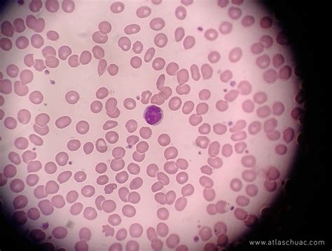 Leucemia Variante De Celulas Pilosas