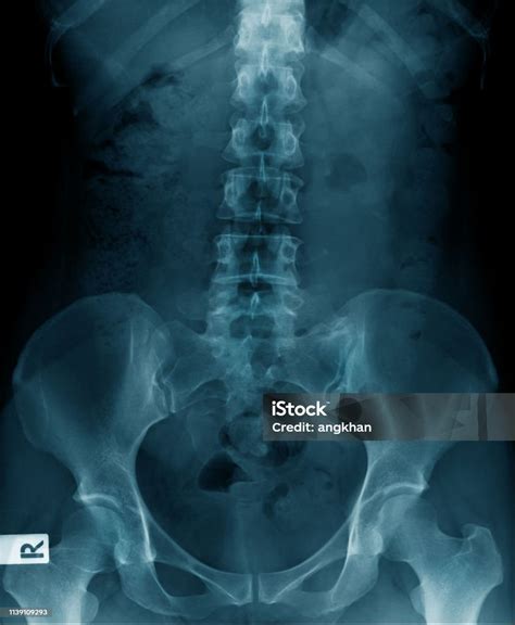 노인 X 선 골반 뼈가 있는 요 추 X 선 이미지 건강관리와 의술에 대한 스톡 사진 및 기타 이미지 건강관리와 의술 골다공증 골절 Istock
