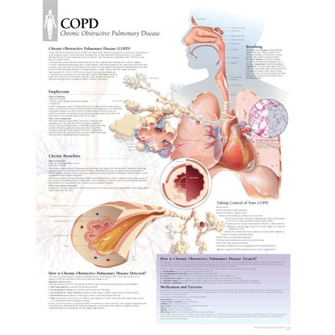 Copd Chart