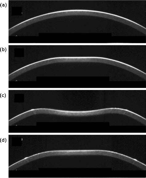Corneal Deformation In Corvis St Measurement A Cornea Deforms After
