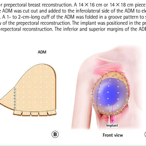 Surgical Technique Of Prepectoral Implant Based Breast Reconstruction Download Scientific Diagram