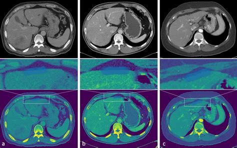 Examples Of Hepatic Surface Nodularity Measurement From Portal Venous Download Scientific