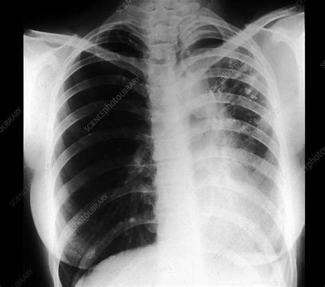 Bronchiectasis X Ray Stock Image C029 9820 Science Photo Library
