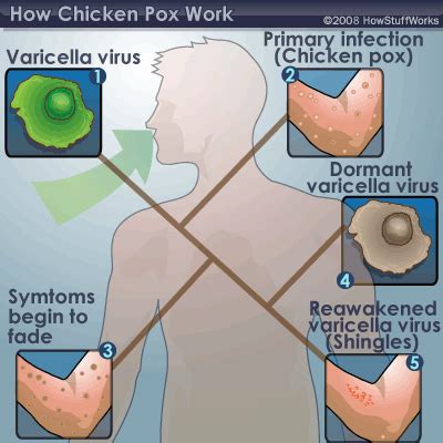 Chicken Pox Symptoms HowStuffWorks