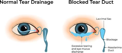 Normal Tear Drainage Vs Blocked Tear Duct Illustration 60263984 Vector