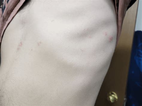 Anybody Have It Come Back After Finishing Antivirals R Shingles