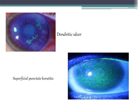 Corneal Ulcers