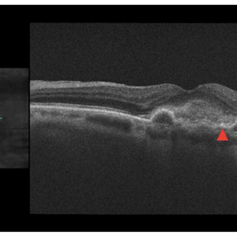 Srhm And Ped In Age Related Macular Degeneration On Optical Coherence