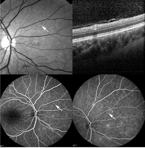 Intraretinal Microvascular Abnormality Semantic Scholar