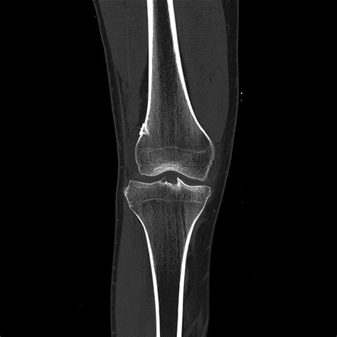 Ct Knee Radiology Imaging