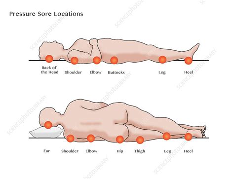 Pressure Sore Locations Diagram Stock Image C0306113 Science