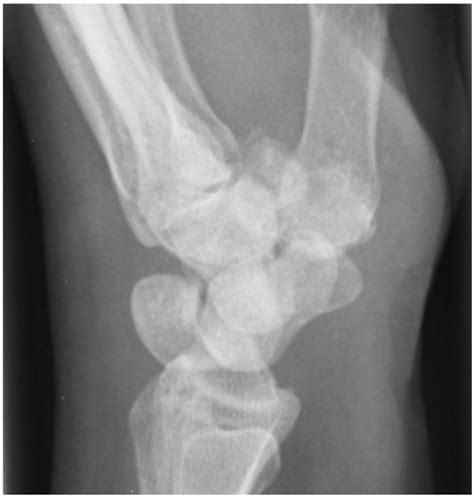 Lateral Radiograph Clearly Showing The Dorsally Dislocated Lunate