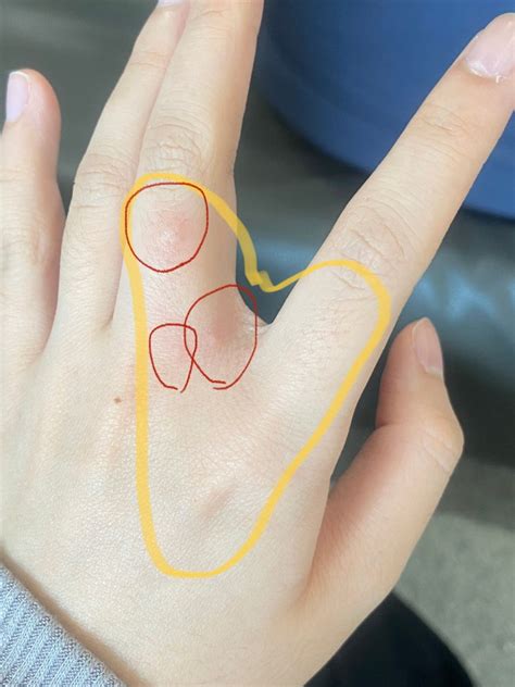 손에 작은 발진과 물집 지식in