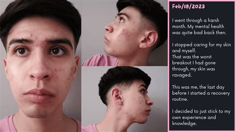 Beforeandafter My 15 Year Skincare Journey The Battle Against Acne
