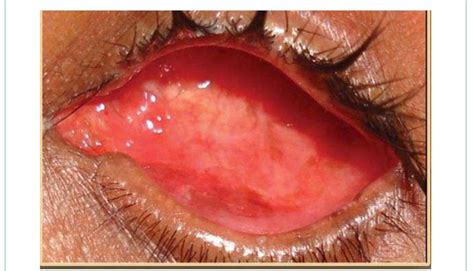 Preoperative Photo Of Ocular Defect An Ocular Prosthesis Is