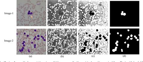 Figure 1 From Gray Level Co Occurrence Matrix And Random Forest Based Acute Lymphoblastic