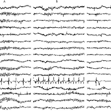 Simultaneous Electroencephalographic Eeg And Cardiac Recordings Download Scientific Diagram