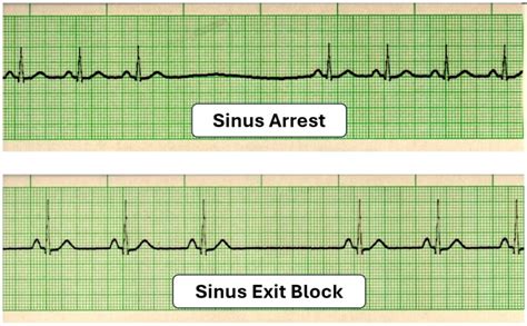 Ekg Detective Sinus Arrest Vs Sinus Exit Block