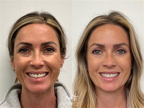 Botox Before And After Masseter Botox What To Know About The