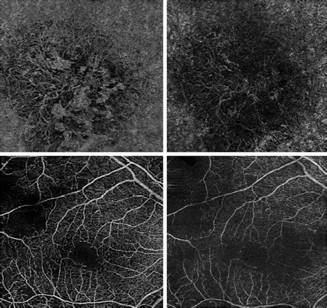 Octa Segmentation Layers On Zeiss Ss And Sd Notes Two Cases Shown As Download Scientific