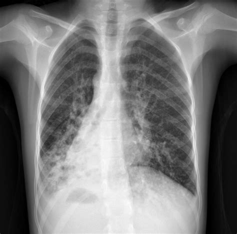 Productive Cough Revealing A Rare Case Of Bronchiectasis Eurorad