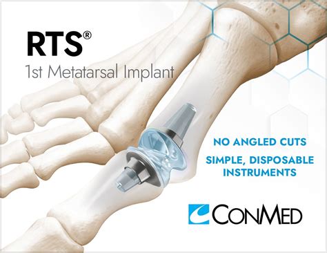 Conmed Footandankle Referencetoesystem Firstmtp Arthroplasty Conmed Foot And Ankle