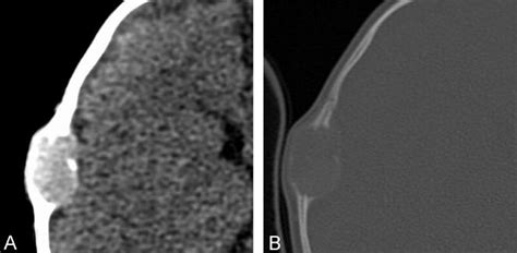 Axial Ct Images A And B Of The Head Demonstrating Cranial Fasciitis Download Scientific