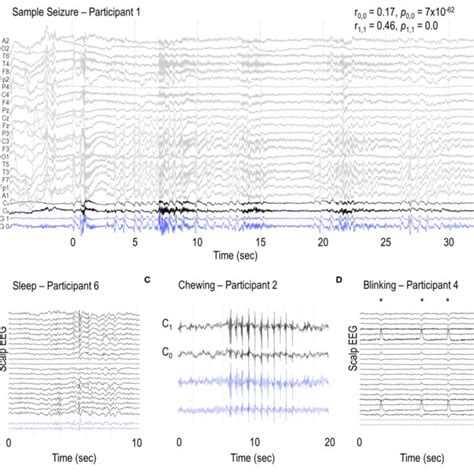 Sample EEG Recordings A Sample Seizure In Participant And Download Scientific Diagram