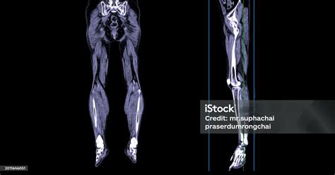 A Ct Venogram Of The Leg Is A Noninvasive Imaging Procedure Offering