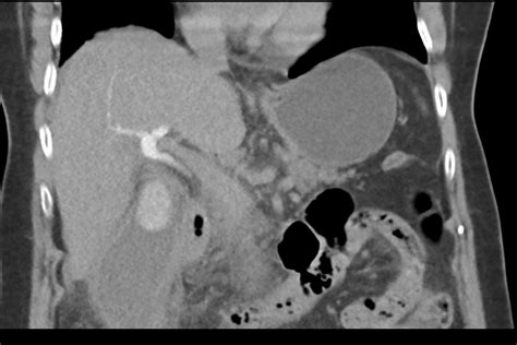 radiopaedia case cholecystitis obstructive choledocholitiasis ct intravenous cholangiography