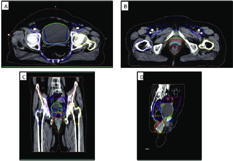 Contouring Volumes Of The Pelvic Lymph Nodes In A The Axial View