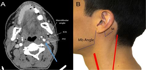 Posterior Cervical Triangle Approach For Carotid Endarterectomy Technical Note And Results