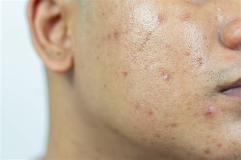 Adapalene Differin Vs Tretinoin Which Is Best For Acne