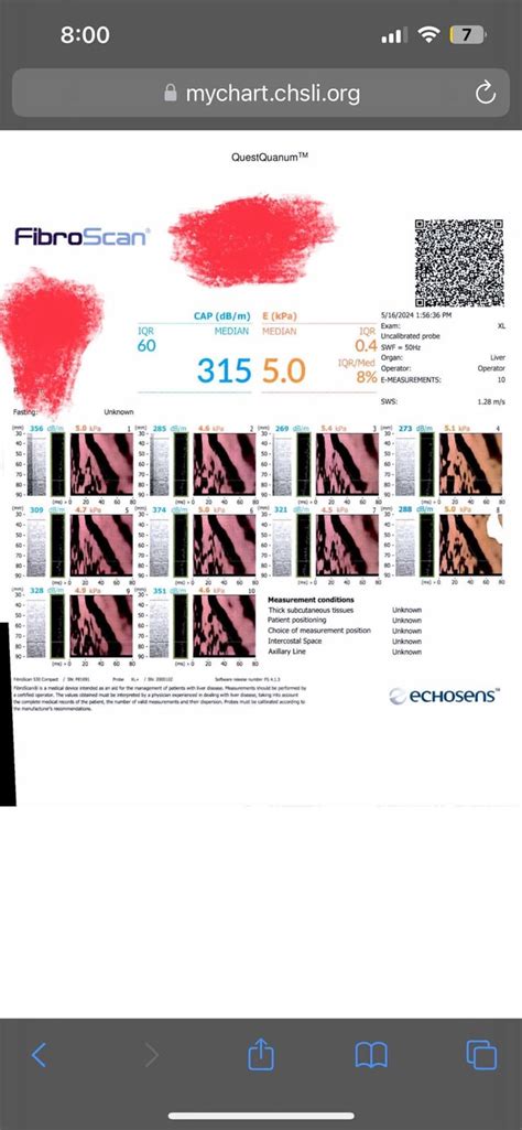 Fibroscan Results R Bdsm Test Results