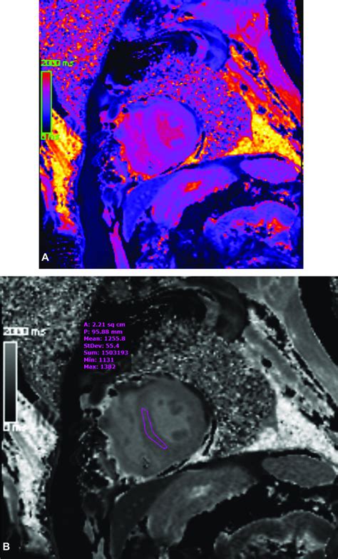 A T1 Map Pre Contrast Of The Left Ventricle And B T1 Map