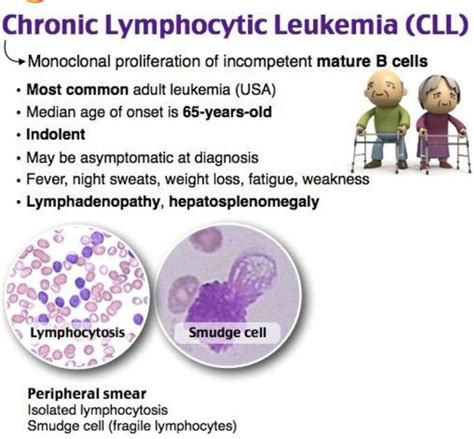 Chronic Lymphocytic Leukemia Medizzy
