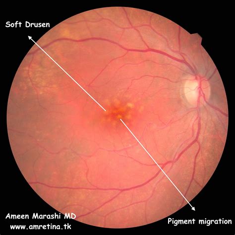 Drusen In Non Neovascular Armd And Subtypes