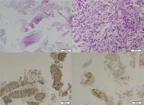Pathology Results A Ebus Lymph Node Station 4r Fragments Of Download Scientific Diagram