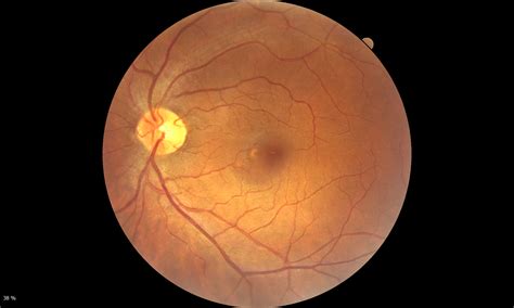 Myopia Detection Classification Model By University