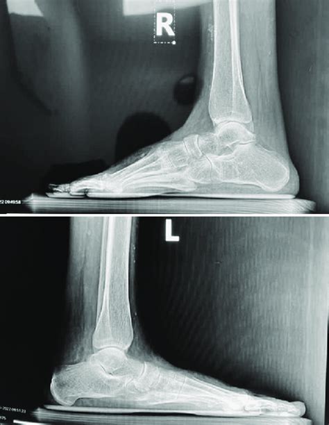 Radiograph Showing Lateral View Of The Deformity Figure 3 Radiograph Download Scientific