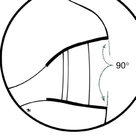 Unit 9 Class 2 Preparation And Restoration With Composite Flashcards Quizlet