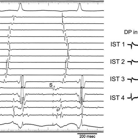 Pdf A Novel Radiofrequency Catheter Ablation Technique For Creation Of Cavotricuspid Isthmus