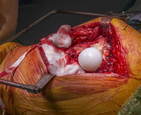 Revision Total Hip Replacement Stryker Custom Acetabulum And Serf Dual