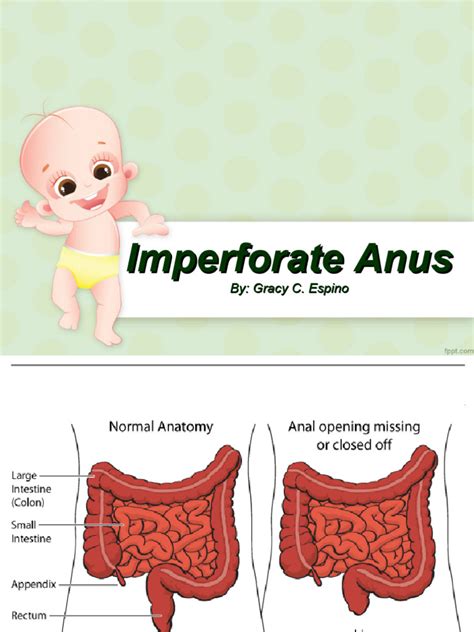 Imperforate Anus Pdf Gastrointestinal Tract Rectum