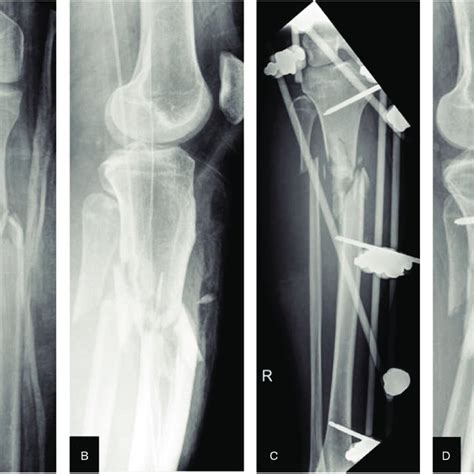 First Stage Masquelet Procedure Showing The Insertion Of The Cement Download Scientific Diagram
